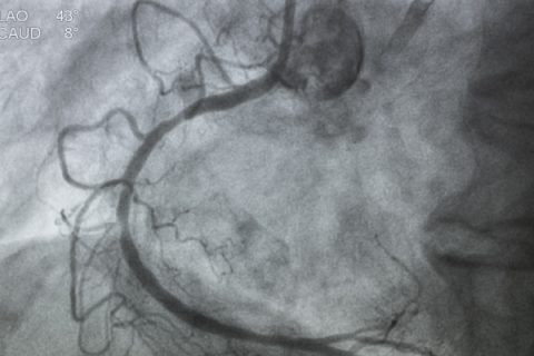 Coronary Angiography & Stenting Procedures - Auburn Cardiology Centre ...